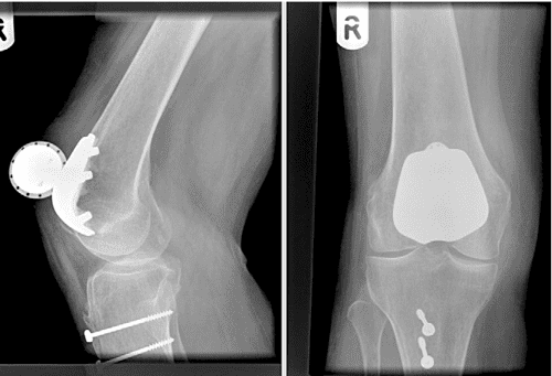 The use of a tantalum-based Augmentation Patella in patients with a ...