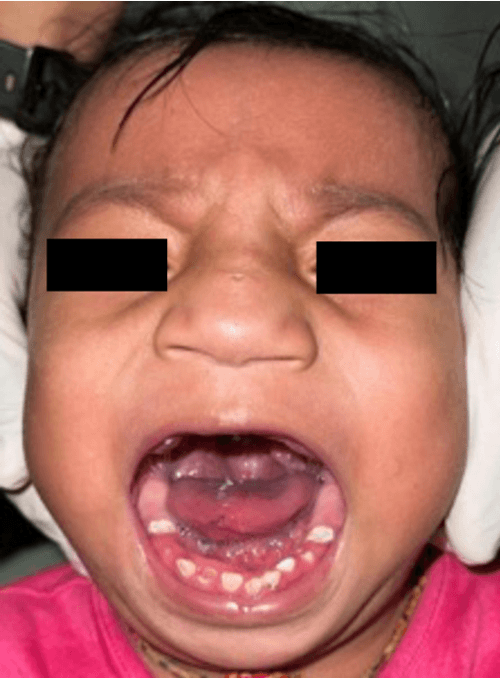 Figure 4 from Bifid Tongue and Cleft Palate: A Rare Congenital ...