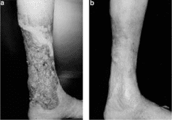Figure 2 from Surgical removal of ulcer and lipodermatosclerosis ...