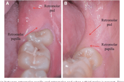 [PDF] Comprehensive understandings in the shape of retromolar pad and ...