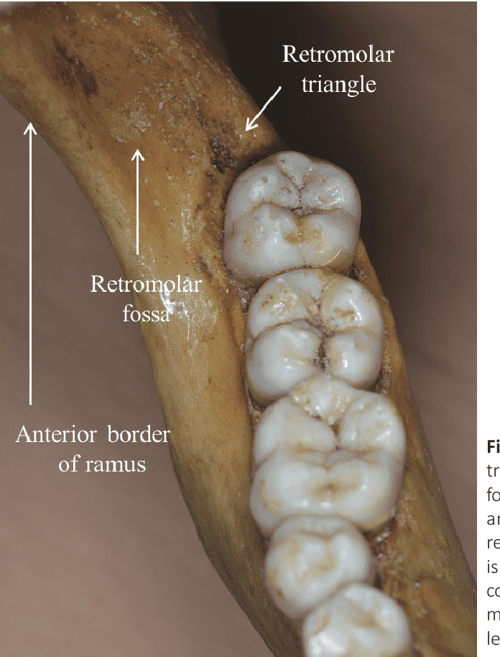 [PDF] Comprehensive understandings in the shape of retromolar pad and ...