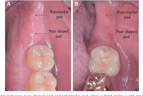 [PDF] Comprehensive understandings in the shape of retromolar pad and ...