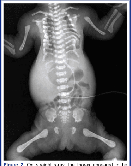Hypertrophic cardiomyopathy with Jeune syndrome: The first reported ...