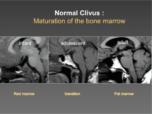 The Clivus Lesions: Crossroads Of Skull Base | Semantic Scholar