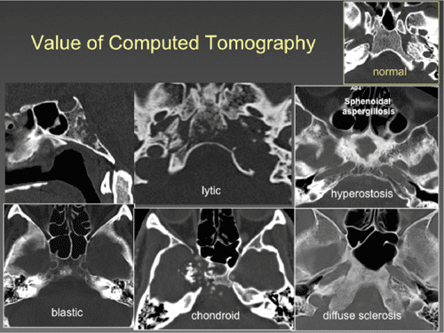 The Clivus Lesions: Crossroads Of Skull Base | Semantic Scholar