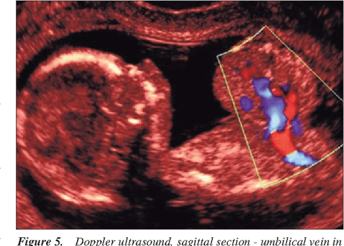 Differential diagnosis of abdominal wall defects - omphalocele versus ...