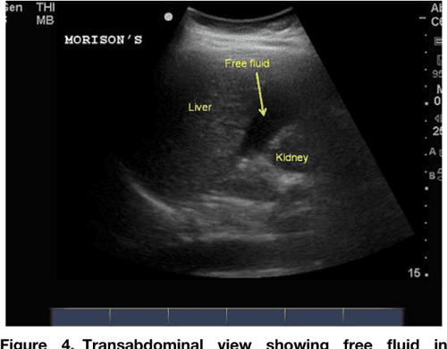 Point-of-care ultrasound diagnosis of a ruptured live ectopic pregnancy ...