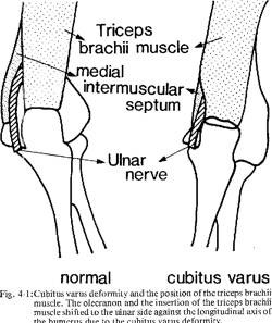 Figure 2 from Tardy Ulnar Nerve Palsy Caused by Cubitus Varus Deformity ...