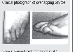 Figure 1 from Fifth Toe Deformities | Semantic Scholar
