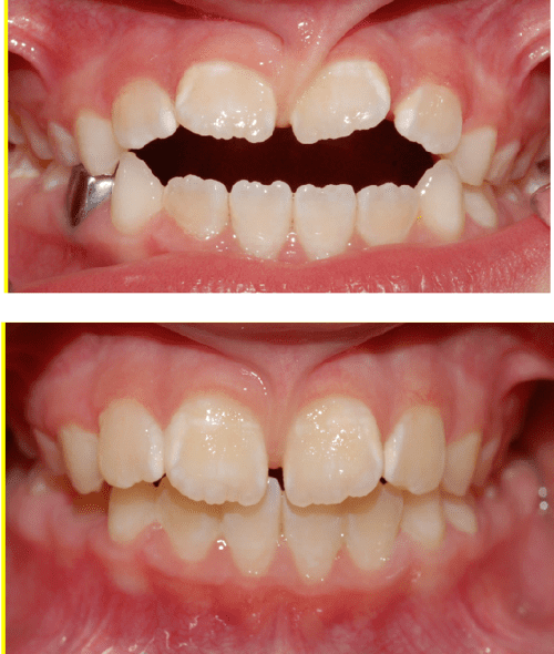 Bondable lingual spur therapy to treat anterior open bite | Semantic ...