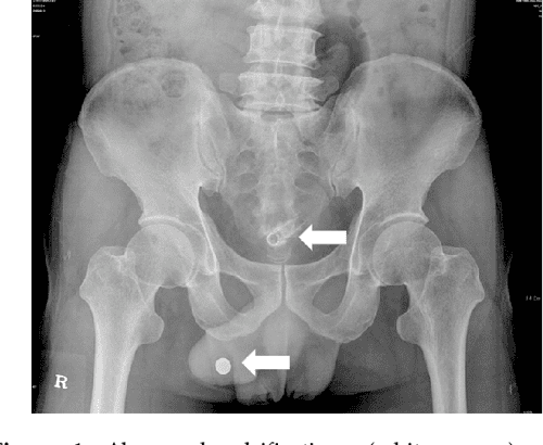 Figure 2 from Unusual foreign bodies in the urinary bladder and urethra due to autoerotism ...