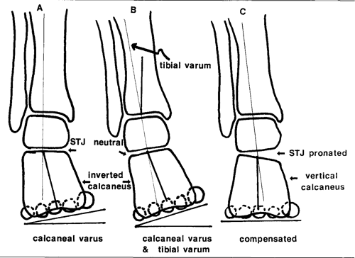 [PDF] Pathomechanics of structural foot deformities. | Semantic Scholar