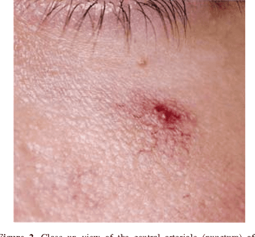 Figure 13 from Skin manifestations of liver diseases. | Semantic Scholar
