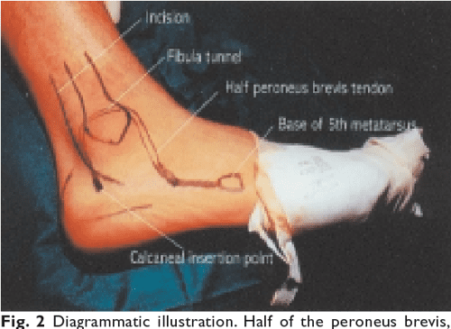 Figure 2 from Chrisman-Snook ankle ligament reconstruction outcomes--a ...