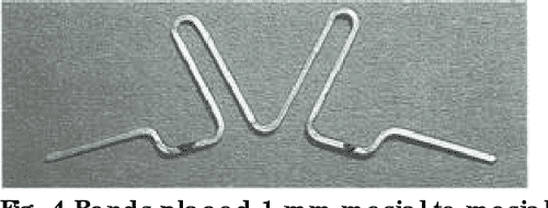 [PDF] The K-loop molar distalizing appliance. | Semantic Scholar