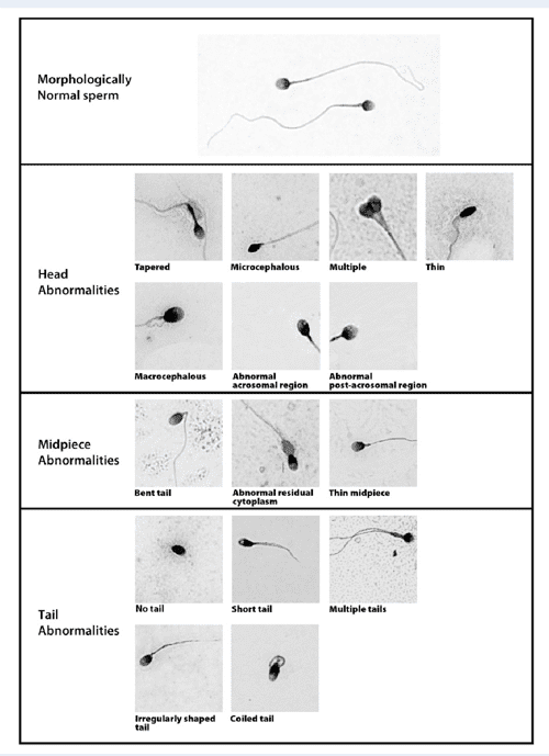 Figure 1 from Another look at human sperm morphology. | Semantic Scholar