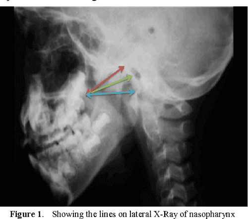 Table 2 from Significance of Adenoid Nasopharyngeal Ratio in the ...