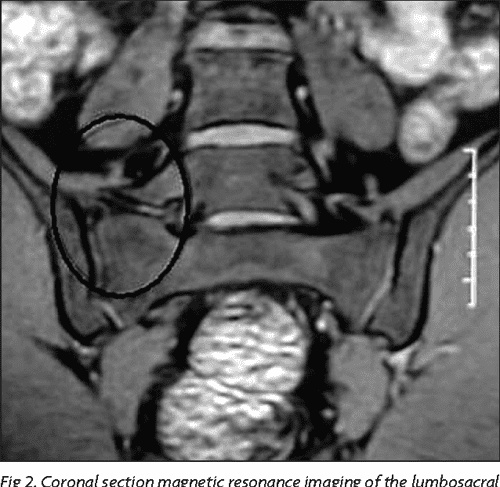 Figure 2 from Transitional lumbosacral vertebrae and low back pain ...