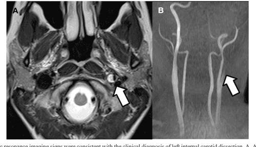 Figure 1 from Carotid artery dissection presenting with isolated ...
