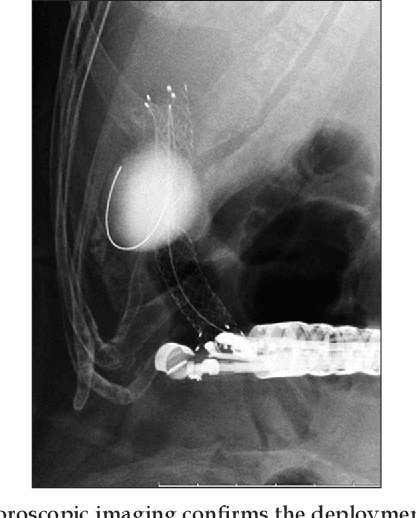Double puncture of the stomach and duodenum during EUS-guided ...