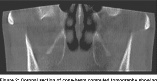Figure 5 from The Pterygoid Hamulus Syndrome – An Important ...