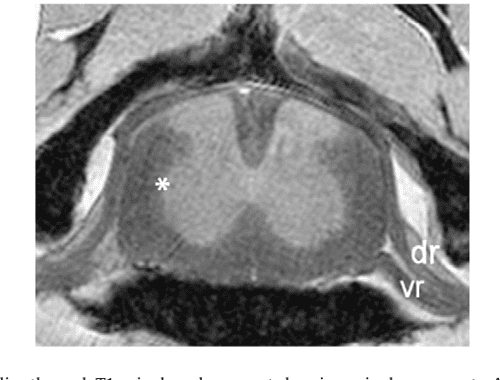 [PDF] Vertebral landmarks for the identification of spinal cord ...