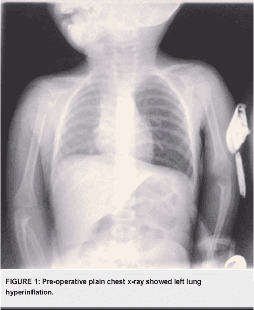 [PDF] Foreign Body Aspiration in a Child With a Rare Tracheal Bronchus ...