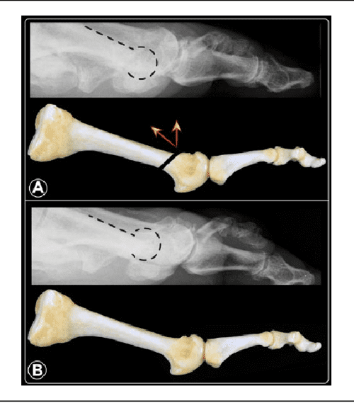 Minimally Invasive Distal Metatarsal Diaphyseal Osteotomy (DMDO) for ...