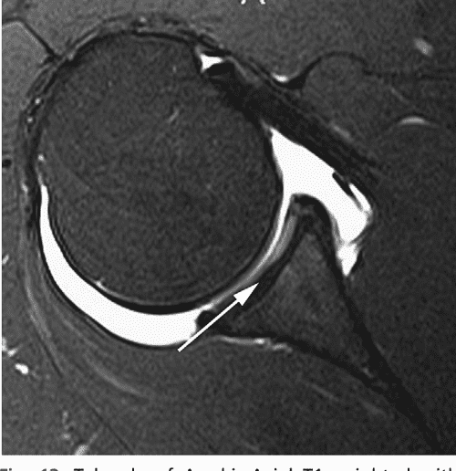 Figure 8 from Normal and variant anatomy of the shoulder on MRI ...