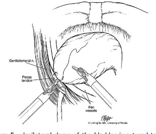 Figure 2 from Robotic distal ureterectomy with psoas hitch and ...