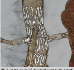 Balloon guidance for superior mesenteric artery scallop alignment ...