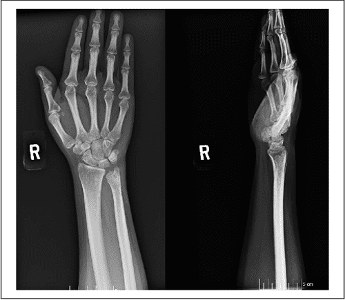 Figure 2 from Isolated Distal Ulna Fracture With Distal Radioulnar ...