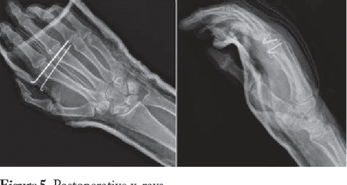 Figure 4 from Complex lesion of the third metacarpophalangeal joint ...