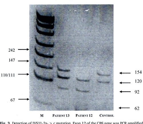 Figure 1 from Homocystinuria due to cystathionine beta-synthase (CBS ...