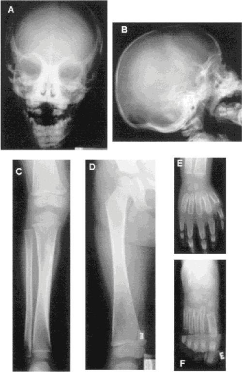 Figure 2 from Mapping of the autosomal recessive (AR) craniometaphyseal ...