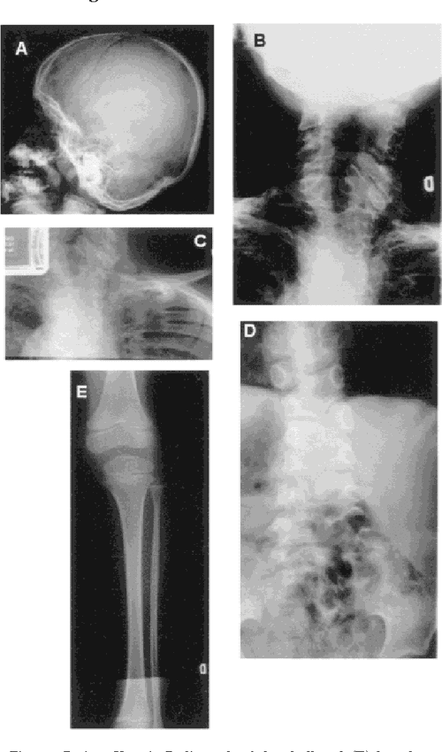 Table I from Mapping of the autosomal recessive (AR) craniometaphyseal ...