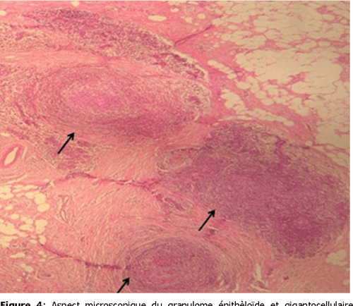 Figure 1 from Tuberculose péritonéale pseudo tumorale mimant un cancer ...
