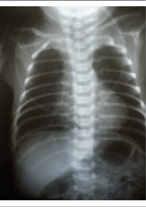 Figure 1 from Congenital Tuberculosis: A Newborn Case Report With Rare ...