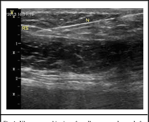 Ultrasound-guided anterior abdominal cutaneous nerve block for the ...