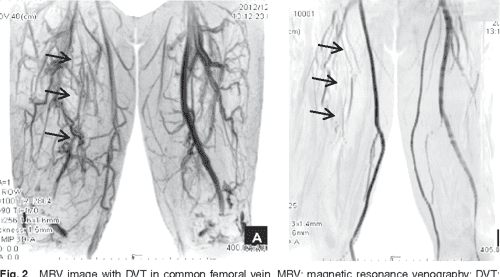 Figure 2 from MR Venography for the Assessment of Deep Vein Thrombosis ...