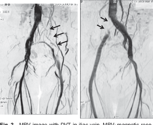 Figure 1 from MR Venography for the Assessment of Deep Vein Thrombosis ...