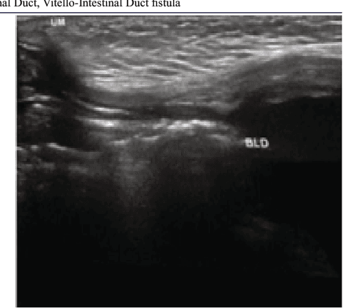 Figure 2 from A CASE REPORT VITELLO-INTESTINAL DUCT FISTULA – A RARE ...