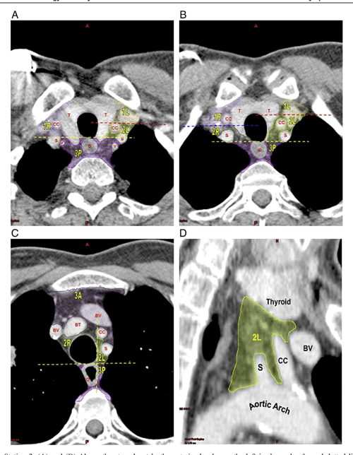 Figure 3 from Computed tomographic atlas for the new international ...