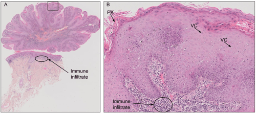 Table 2 from The Pathogenesis of Giant Condyloma Acuminatum (Buschke ...