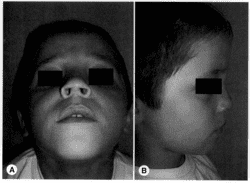 Figure 3 from Reconstruction of the Columella with Bilateral Nostril ...
