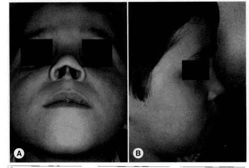Figure 3 from Reconstruction of the Columella with Bilateral Nostril ...