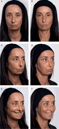 Figure 4 from Injection Guidelines for Treating Midface Volume ...