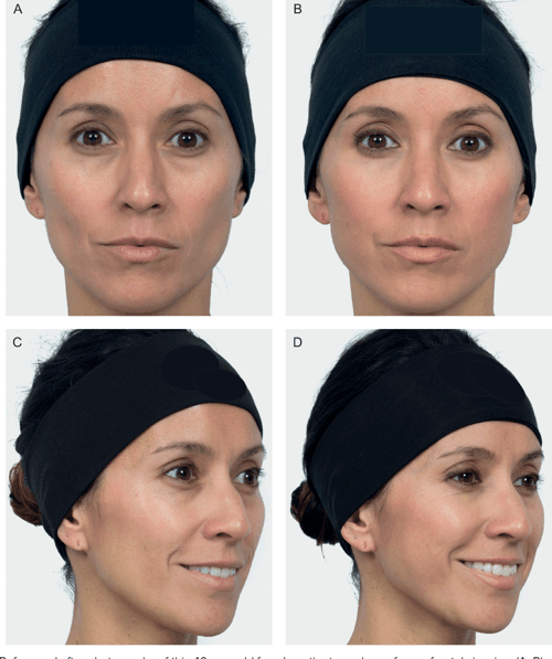 [PDF] Injection Guidelines for Treating Midface Volume Deficiency With ...