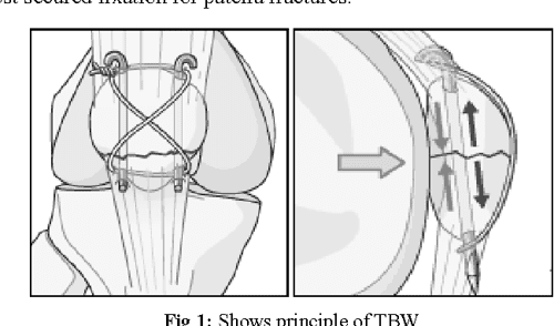 Table 1 from Functional outcome with modified tension band wiring for ...