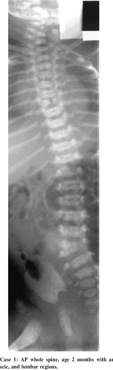 Figure 1 from Spinal Anomalies in Goldenhar Syndrome | Semantic Scholar